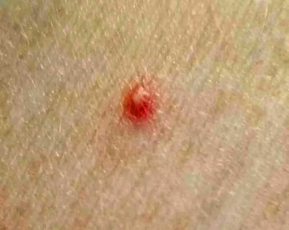 Does this look like DH? - Celiac.com